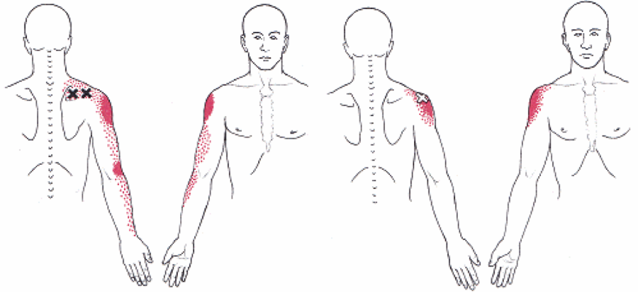 SHOULDER PAIN - ATX Orthopedics
